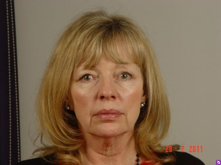 Bridget's Story - Oralift